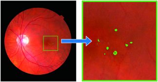 Intelligence artificielle pour l'ophtalmologie - Ophtai